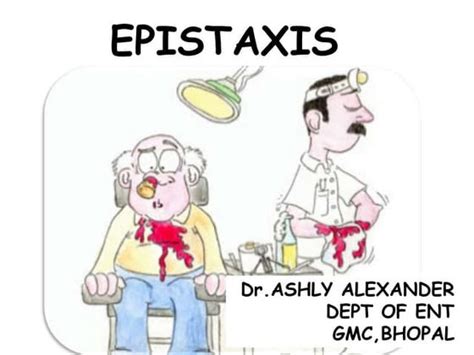 Epistaxis Ppt