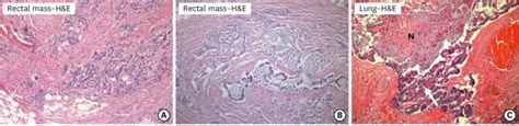 Colonic And Lung Tissues At Autopsy A Histopathology Of Rectal Mass