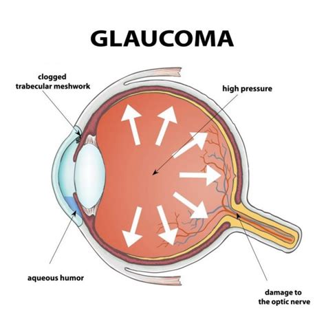 Get A Closer View Of ICD CM Glaucoma Coding AAPC Knowledge Center