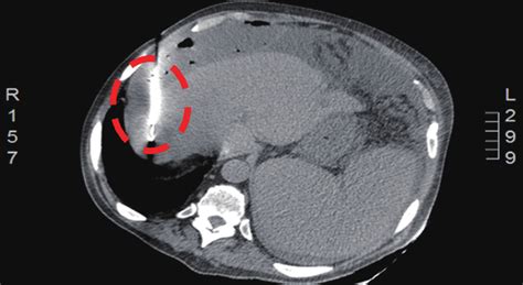 Ct Of Abdomen 9 Days After Abscess Drainage Showing A Percutaneous