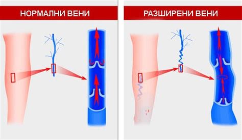 Разширени вени топ 5 причини симптоми и усложнения Ентан