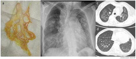 Bronchitis Vs Pneumonia X Ray