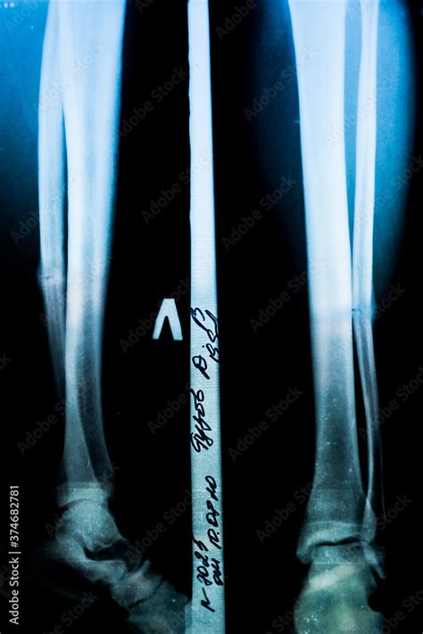 X Ray Of A Patient With A Fracture Of The Fibula Of The Middle Tibia