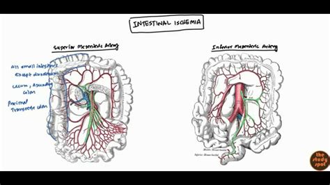 Mesenteric Artery Ischemia