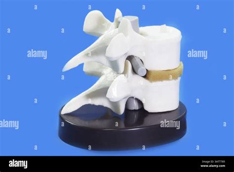 Teaching Model Of The Human Spinal Disc Human Anatomy Spinal Disk On