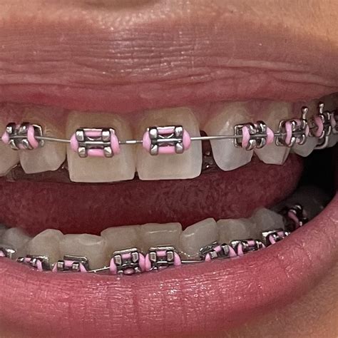 Light Purple Braces