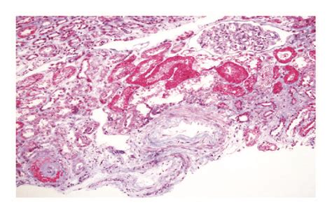 Renal Parenchyma With Glomerular Ischemia A Hematoxylin Y Eosin