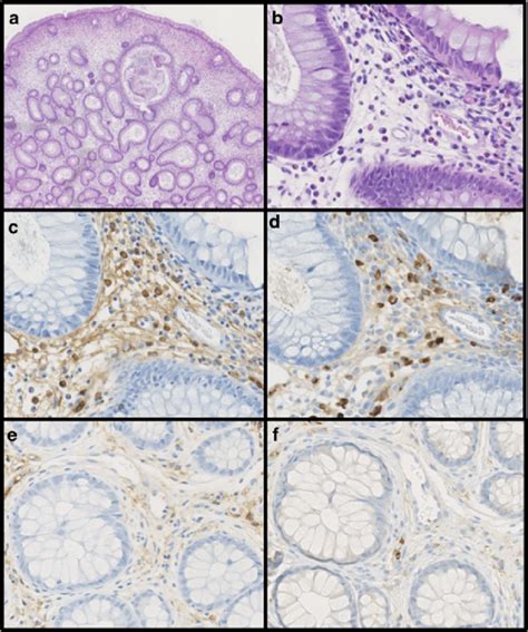 Histologic Findings Of The Colonic Polyp Biopsy Specimen In Case 2