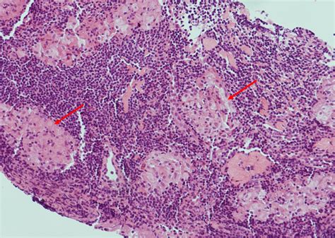 Purulent Bacterial Pericarditis Rare Yet Lethal Jacc Case Reports