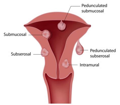 Large Fibroids And Fibroid Treatment Does Size Matter