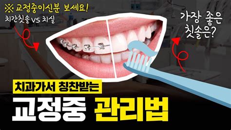 치아교정중 양치질방법 총정리 [워터픽 치간칫솔 첨단칫솔 교정용칫솔 왁스] Youtube