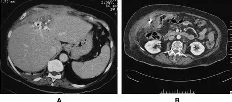 Ct Scan 7 Months Post Hepatectomy A Reaccumulation Of Fluid In The Download Scientific
