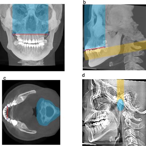 Binarization Of The Mandible A Representation Of The Processed 3d