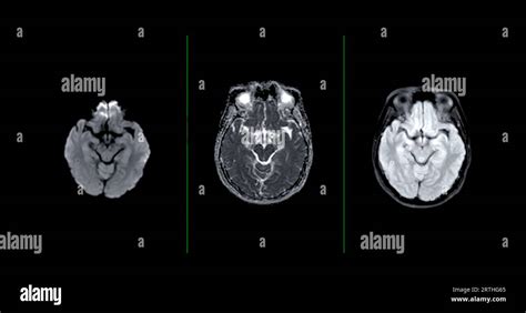 Mri Brain Scan Axial Diffusion Technique For Detect Brain Diseases Sush As Stroke Disease Brain