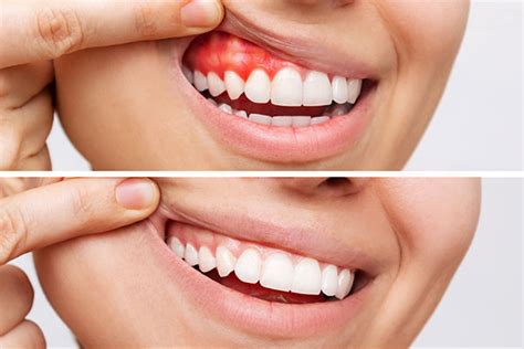 The Stages Of Gum Disease Explained By A Ashland Dentist