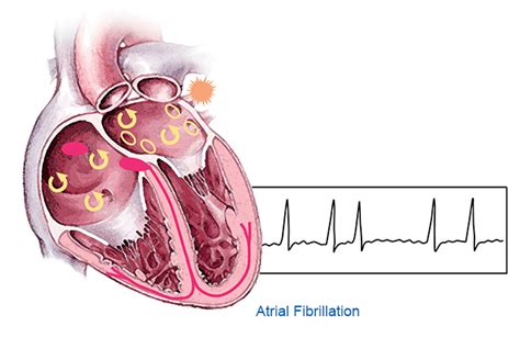 Atrial Fibrillation Johns Hopkins Medicine