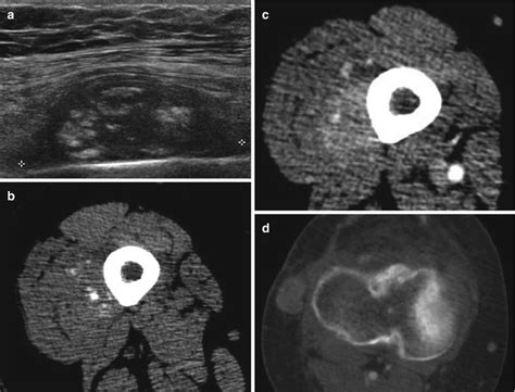 Soft Tissue Metastases Radiology Key