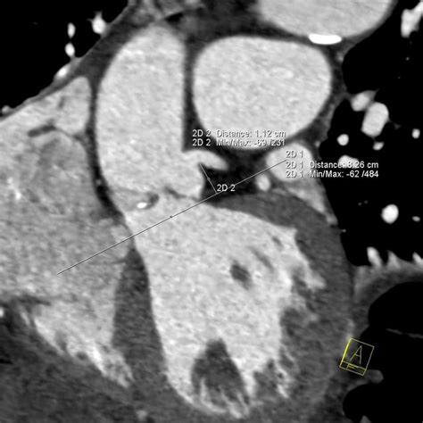 Pdf Ct Measurements Of Aortic Annulus In Patients Who Underwent Tavi