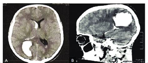 Patient 2 A 13 Year Old Male With Severe Headache Ct Scan