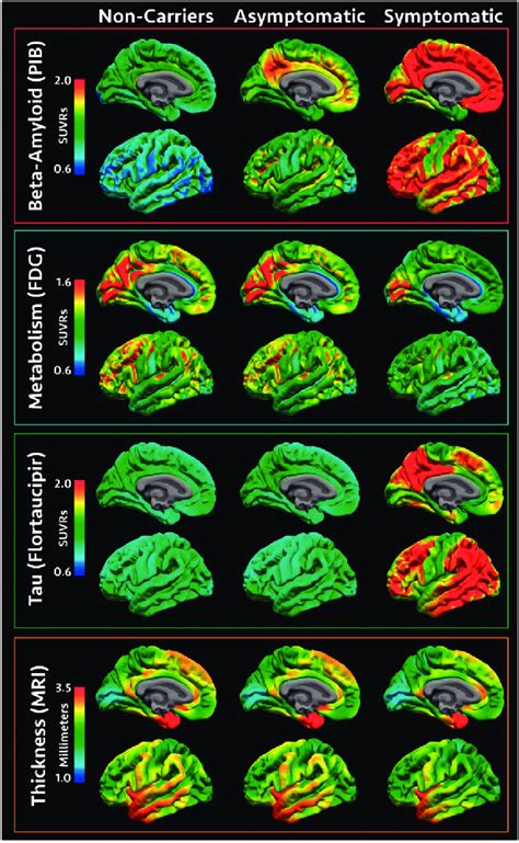 Visualization Of Pathology Across The Cohort Spatial Renderings In