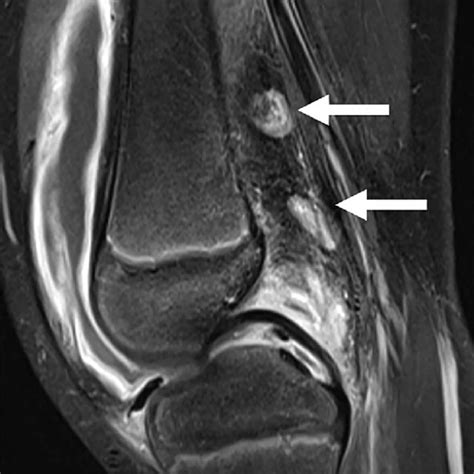 Sagittal T1 Weighted Fat Saturation Post Contrast Mri Scan Of A Knee