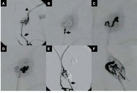 Figure 2 From Simulation Model Of Arteriovenous Malformation