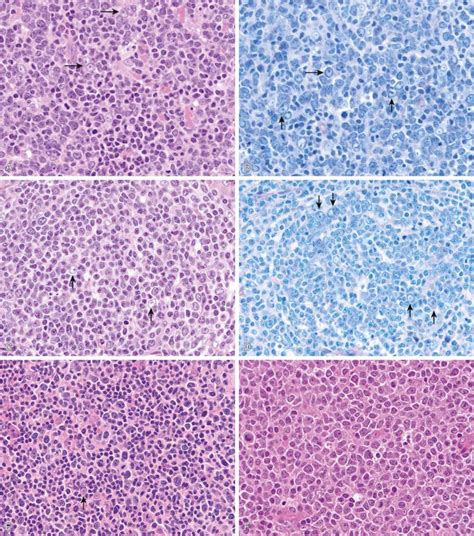 Follicular Lymphoma Clinical Tree