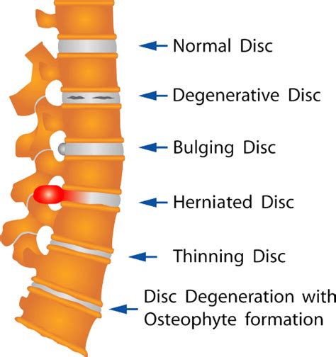 Spinal Decompression Therapy Sydney Chiropractic Spinal Decompression