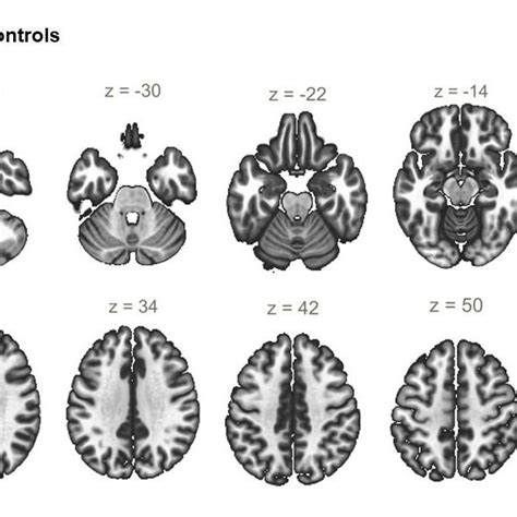 Functional Connectivity Of The Right Anterior Insula Seed And Effect