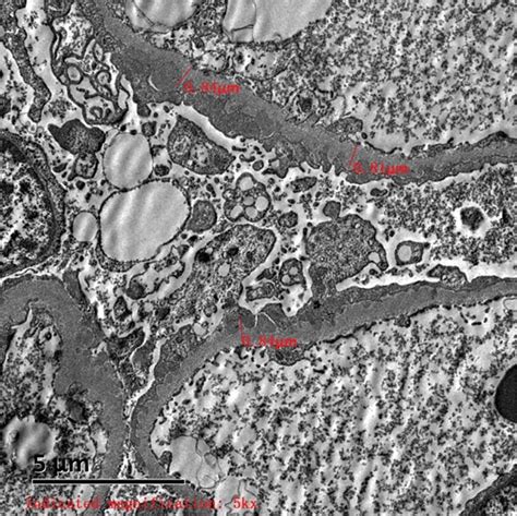 Diffuse Subepithelial Deposition Of Electron Dense Substances Electron Download Scientific