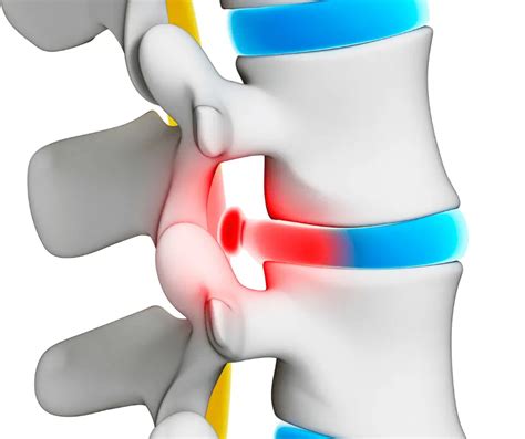 Herniated Disc Settlement With Surgery At William Lawrence Blog