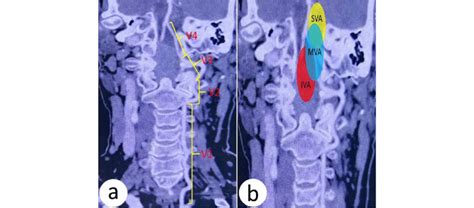 The Segment Of The Vertebral Artery And The Relationship Between Fmm Download Scientific