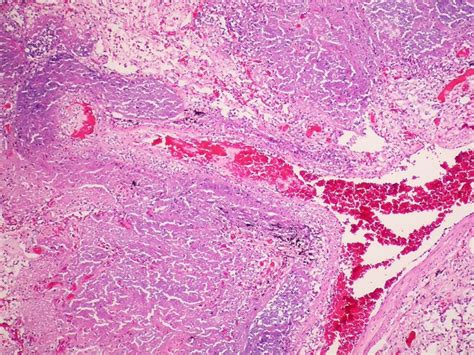 Casi Un 30 De Las Cepas De Tuberculosis Multirresistente Se Transmite Entre Pacientes