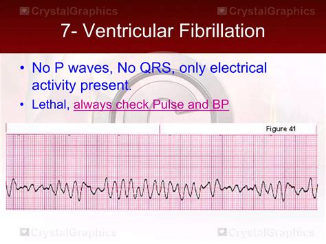 Basic Dysrhythmia Interpretation Pptx Heart And Cardiovascular Diseases Diseases And