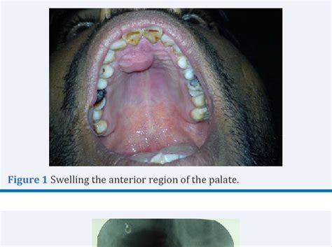Figure 1 From Palatal Swelling Secondary To Radicular Cyst Semantic