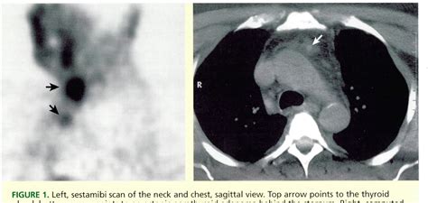 Figure 1 From Asymptomatic Hypercalcemia In A 51 Year Old Woman
