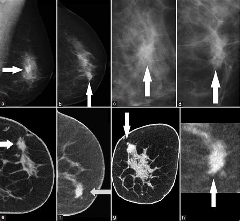 Dedicated Three Dimensional Breast Computed Tomography Lesion Characteristic Perception By