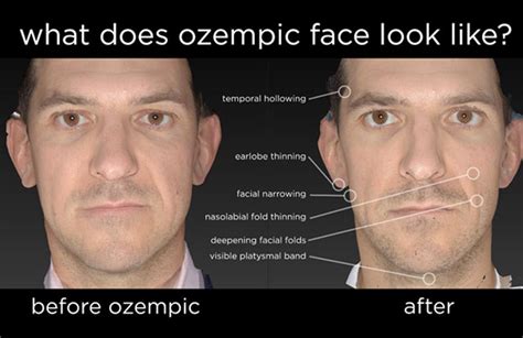 Ozempic Weight Loss Before And After Reddit At John Brunner Blog