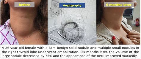 Case Examples Thyroid Goiter