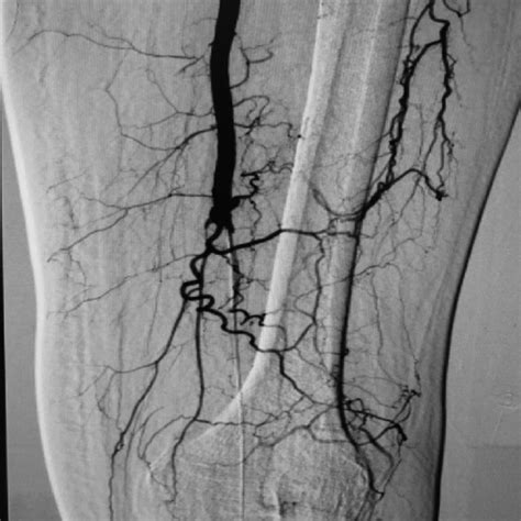 A Left Lower Extremity Lle Angiogram At Time Of Initial