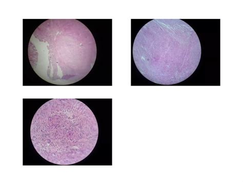 Malignant Gist Of Duodenum Case Report Pptx Digestive Disorders Diseases And Conditions