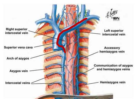 Learning Radiology Central Venous Catheter Azygos Vein