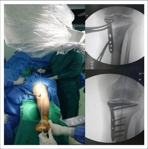 The Cable Method Of Assessing Intraoperative Leg Alignment Is Not Download Scientific Diagram