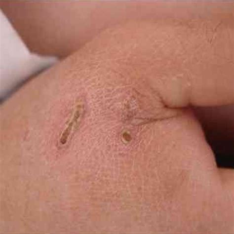 Cutaneous Vasculitis On The Leg Of A 42 Year Old Man With A History Of Download Scientific