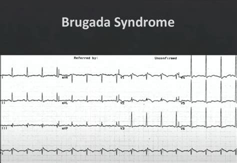 16 55 Another Example And This Is A Bit More Subtle