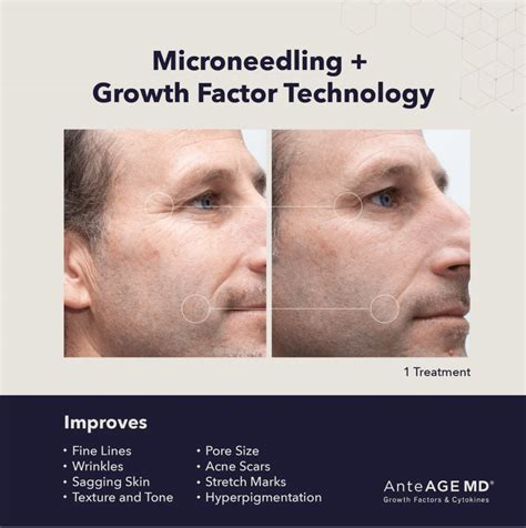 Stem Cell Microneedling Services Spa Mazing Beauty And Wellness
