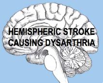 Resulting Dysarthria Hemispheric Stroke Causing Dysarthria