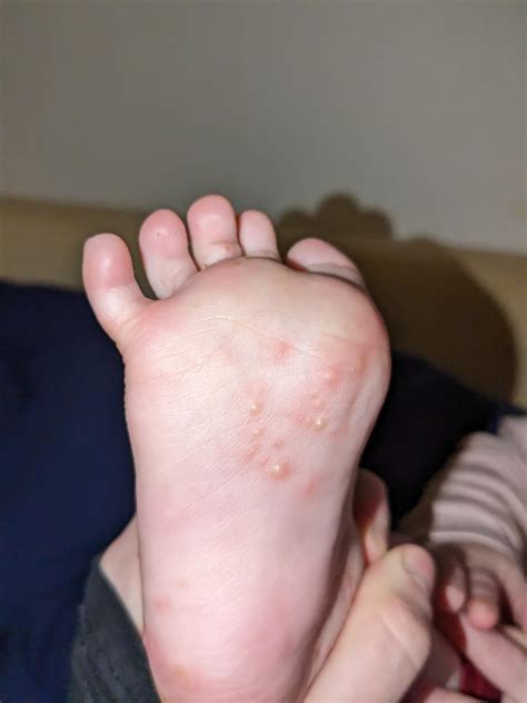 Scabies On Feet Just Wont Go Rscabies
