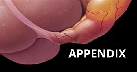 What You Should Know About Appendicitis Marham