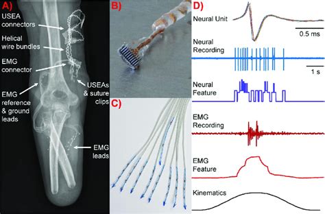 A Two Transradial Amputees Were Implanted With Utah Slanted Electrode Download Scientific